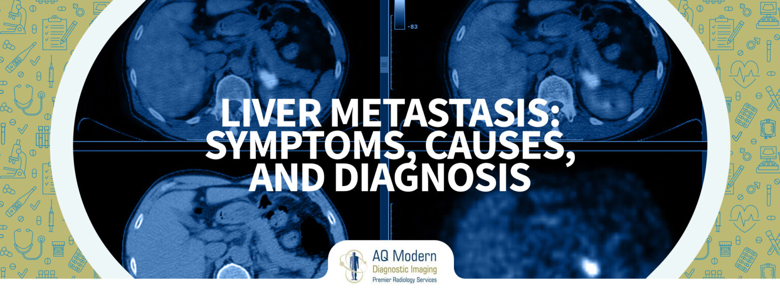 Liver Metastasis: Symptoms, Causes, and Diagnosis
